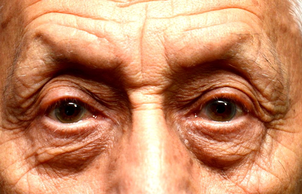 Pérdida de la visión - Salud - ABC Color