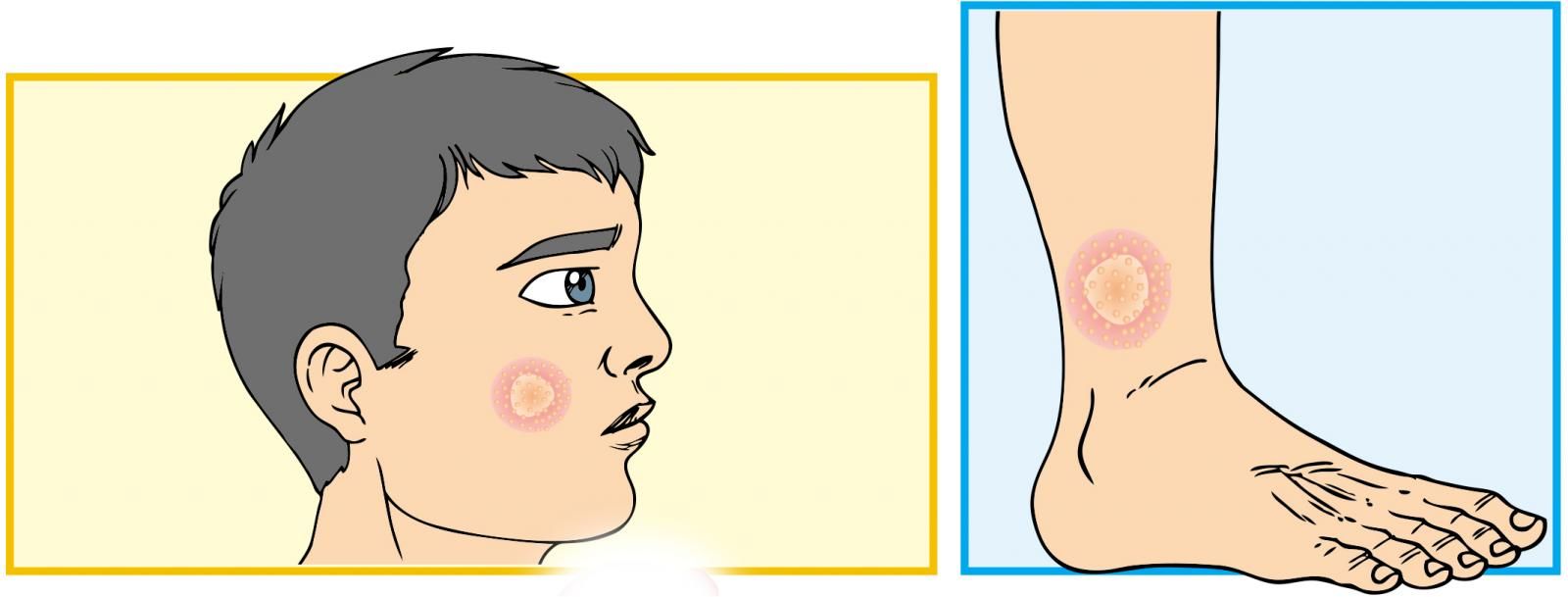 La leishmaniasis - Escolar - ABC Color
