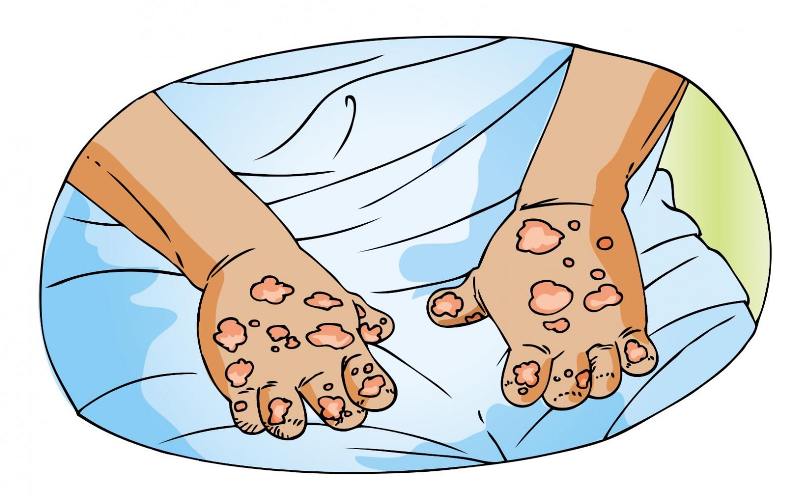 La lepra - Escolar - ABC Color