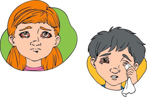 Conjuntivitis en la escuela - Escolar - ABC Color