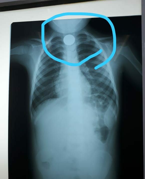 Operan a niño que se tragó una moneda - Nacionales - ABC Color