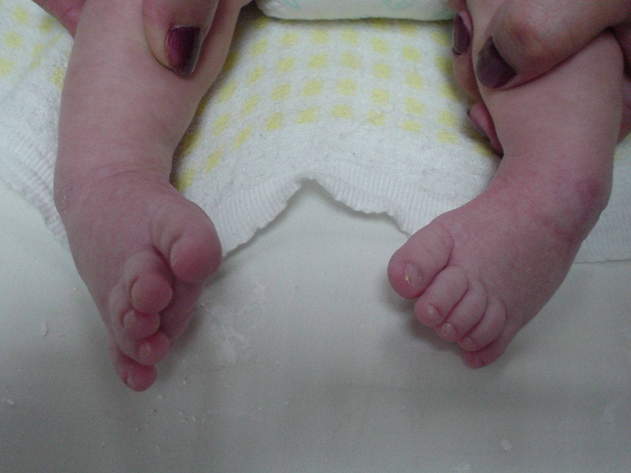 Iniciativa para ayudar a niños con pie bot - Nacionales - ABC Color