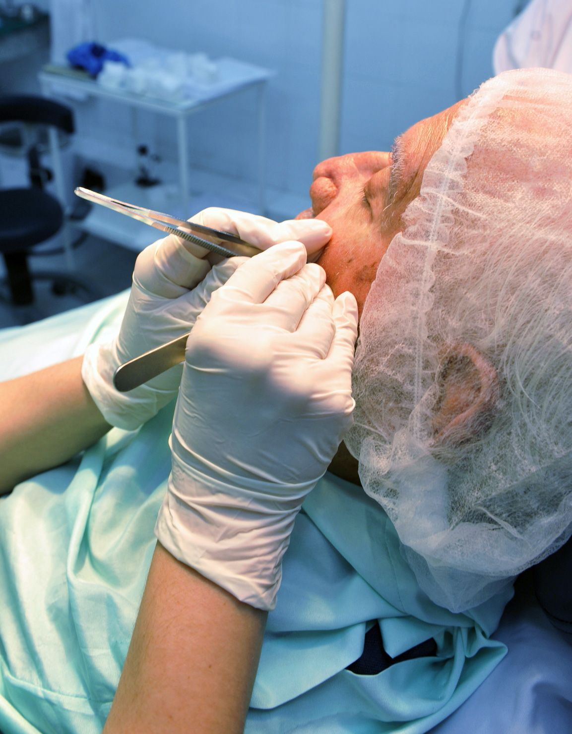 ¿Qué es el melanoma? - Salud - ABC Color